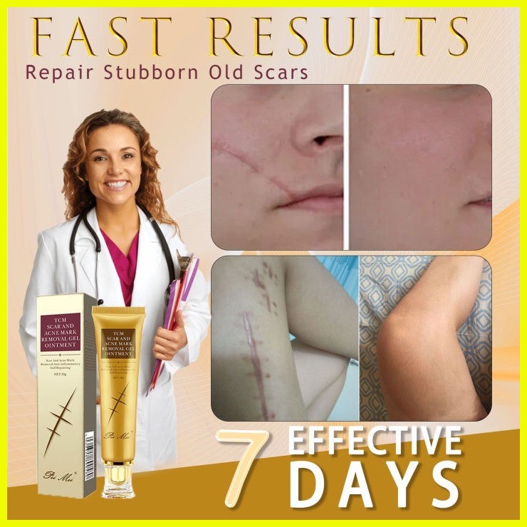 Acne Scar Remover Cream Old Scar Remover Gel Stretch Mark Removal For ...