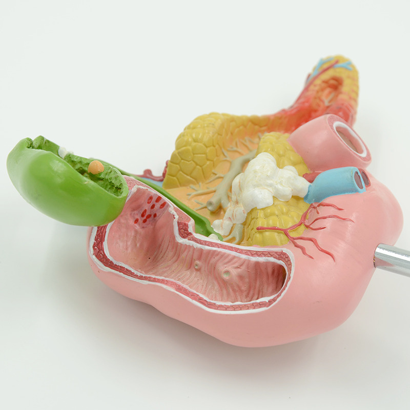 Pathological Of The Pancreas Duodenum And Gallbladder Human Internal ...