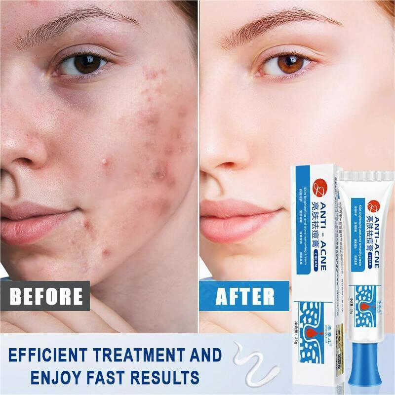 100% Effective Removal 25g Anti Strech Cream Acne Treatment Gel Skin ...