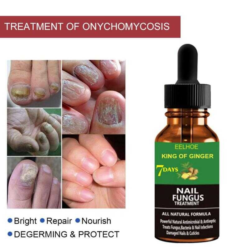 50 Ml Ginger Fungal Treatments Feet Essential Anti-Infections ...