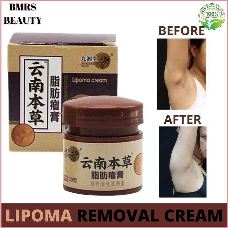 【Jkshop】Fast EFFECT ON HAND Lipoma Removal Cream Treat Tumor Skin ...