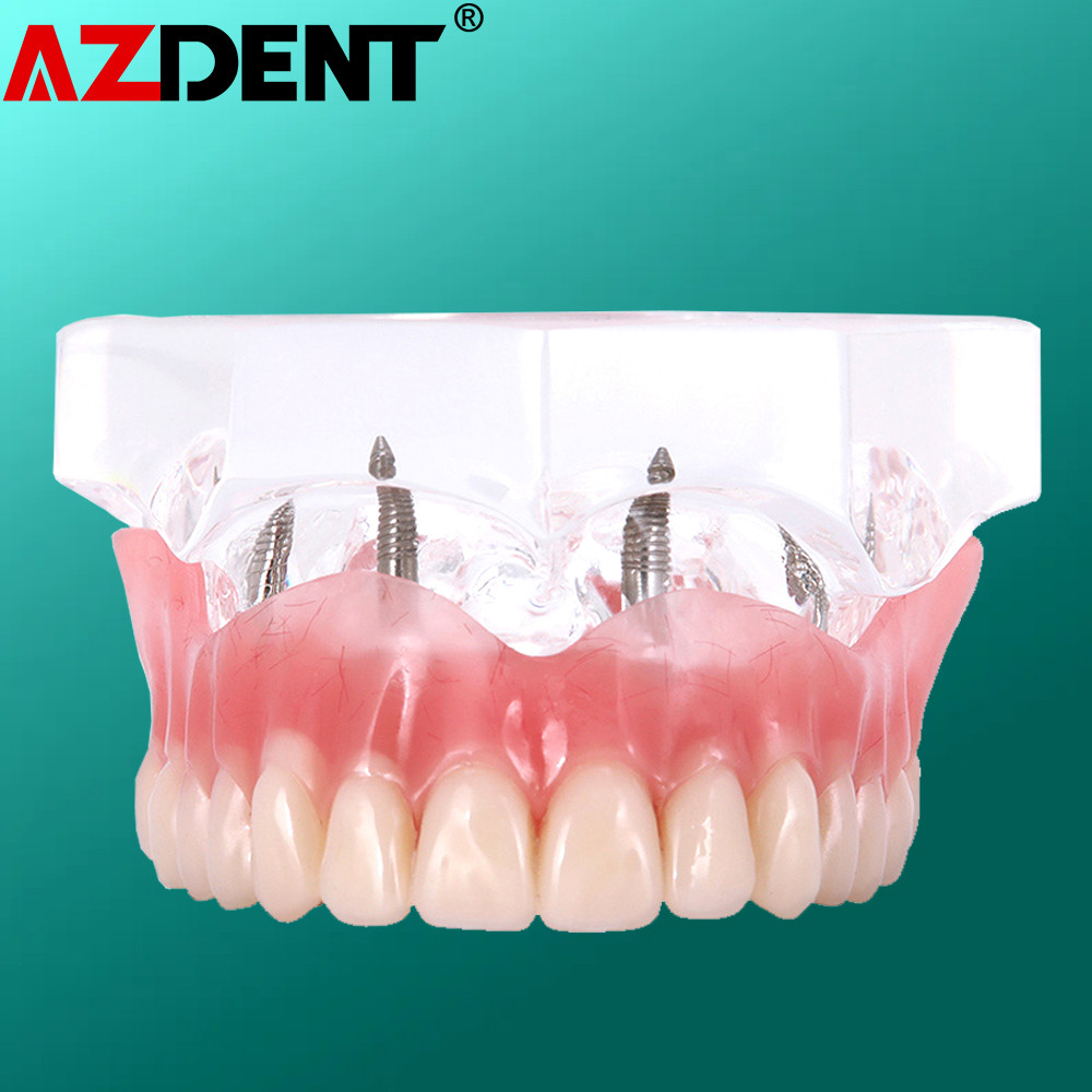 Dental Overdenture Teeth Model Removable Interior Mandibular Lower With ...