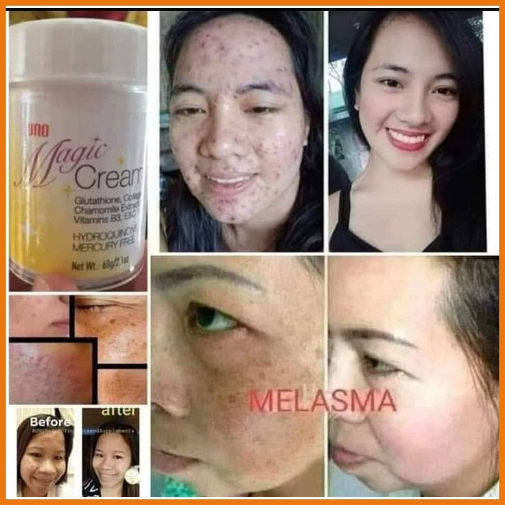 ☸ PANTANGGAL NG PEKLAT, WRINKLES AT PIMPLE MARKS / SCAR REMOVER / MAGIC ...