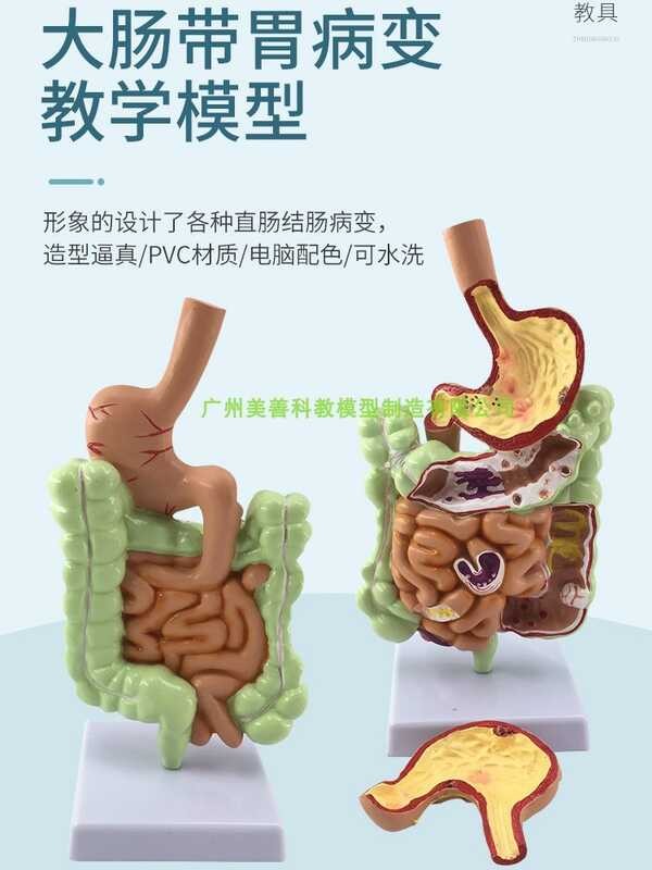 Pathological model of large intestine, anatomical model of ...
