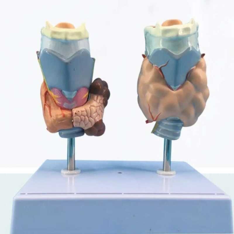 Human Thyroid Pathological Model Hyperthyroidism Model Medical Anatomy ...