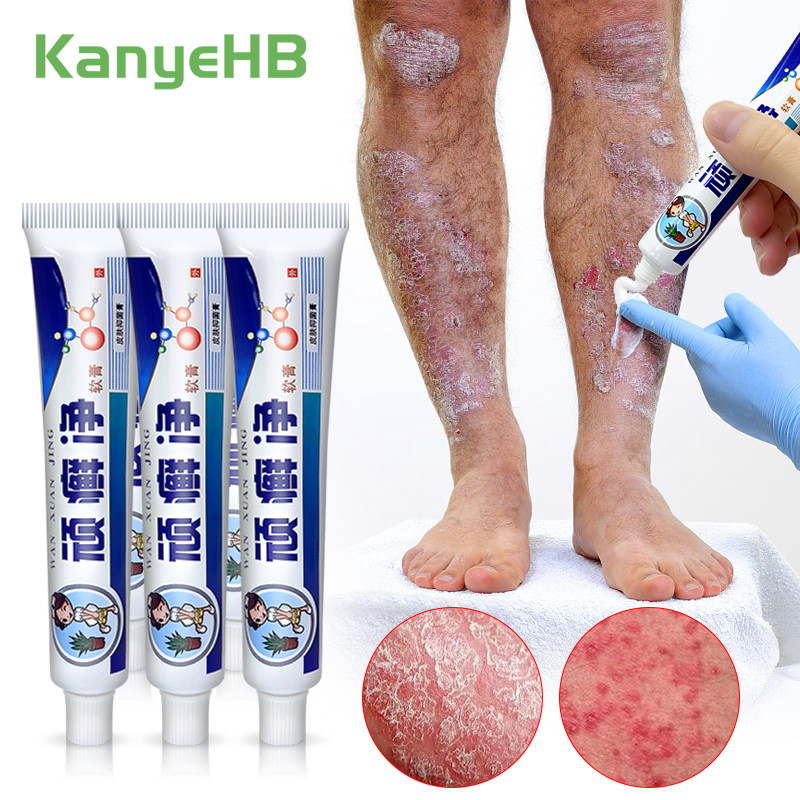 3Pcs Antifungal Dermas Eczema Pityriasis Psoriasis Cream Rash Beriberi ...