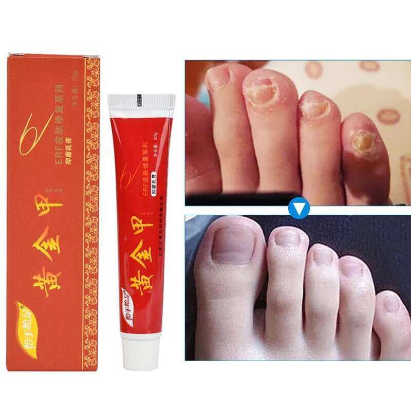 Tt Chinese Medicine Plaster Treatment Cream Onychomycosis Anti Fungal ...