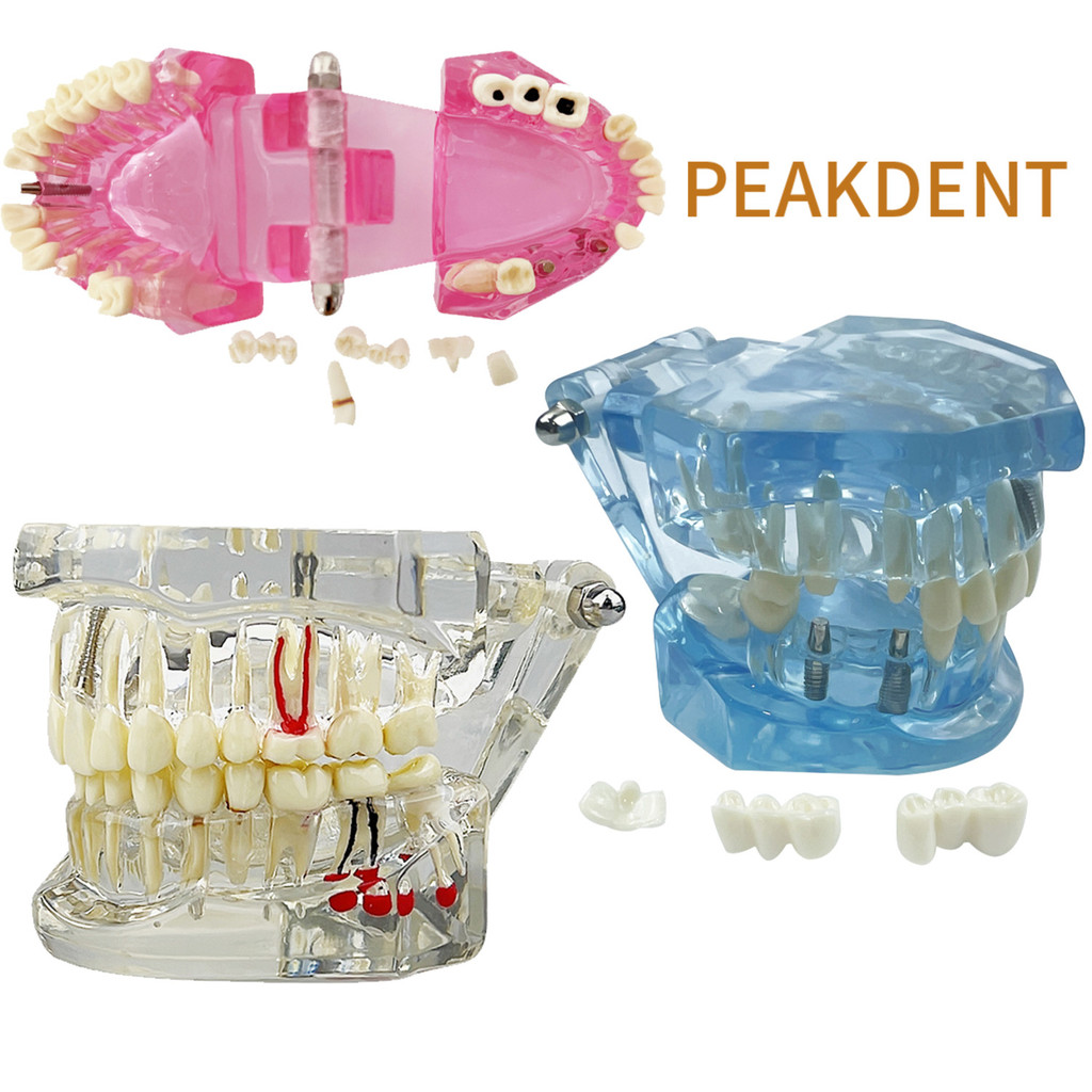 Dental Implant Teaching Study Typodont Model With Removable Teeth ...