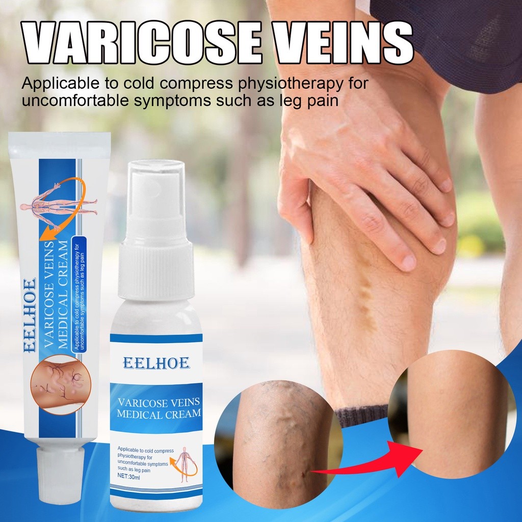 in stock Varicose Veins Ointmnet Vasculitis Phlebitis Spider Cream ...