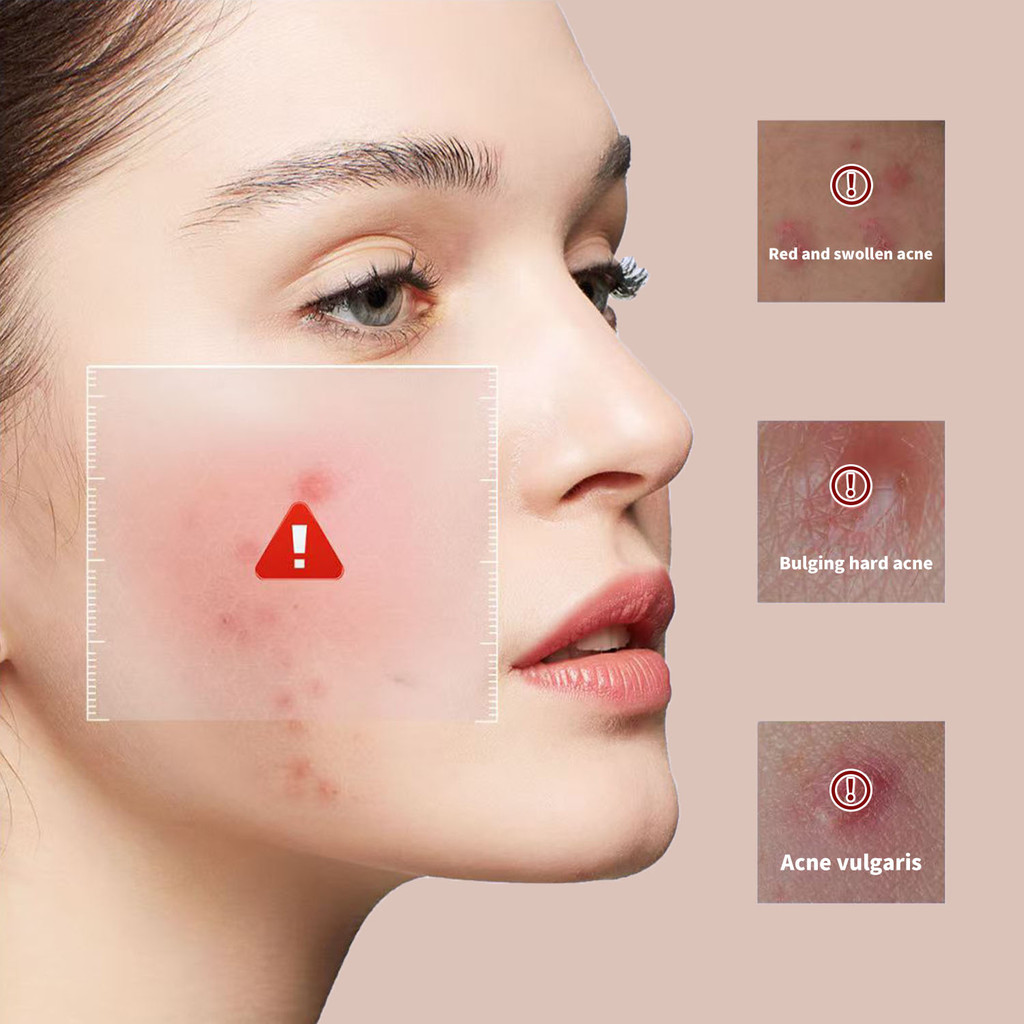 Targeted Key Treatment Salicylic Acid Acne Patch - Safe Harmless ...
