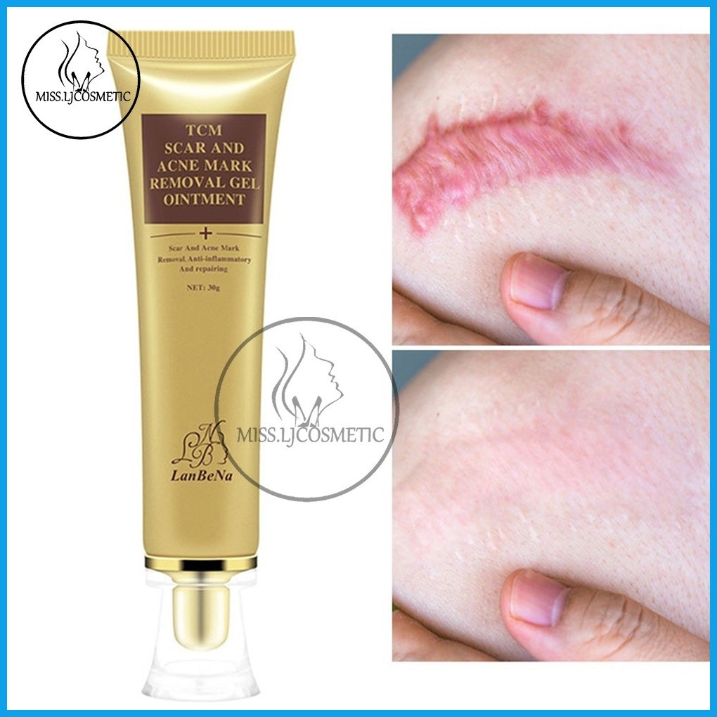 ♒ Original Labena TCM Scar And Acne Mark Removal Gel Ointment | Shopee ...