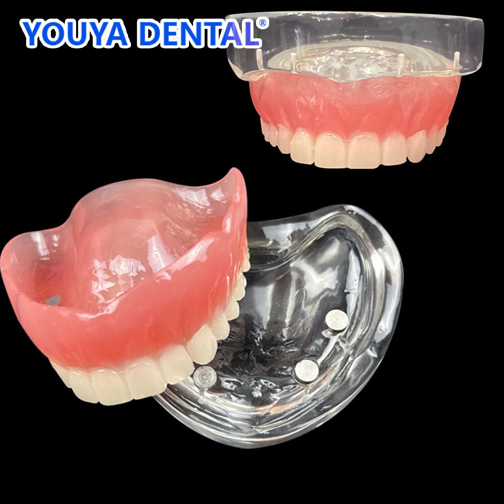 Dental Upper Overdenture Teeth Model Magnetic Adsorption Removable ...