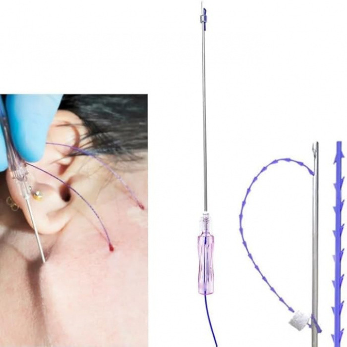 Minerva Fishbone Pdo Threads for Face lift - PDO Cog Threads Whole Body ...