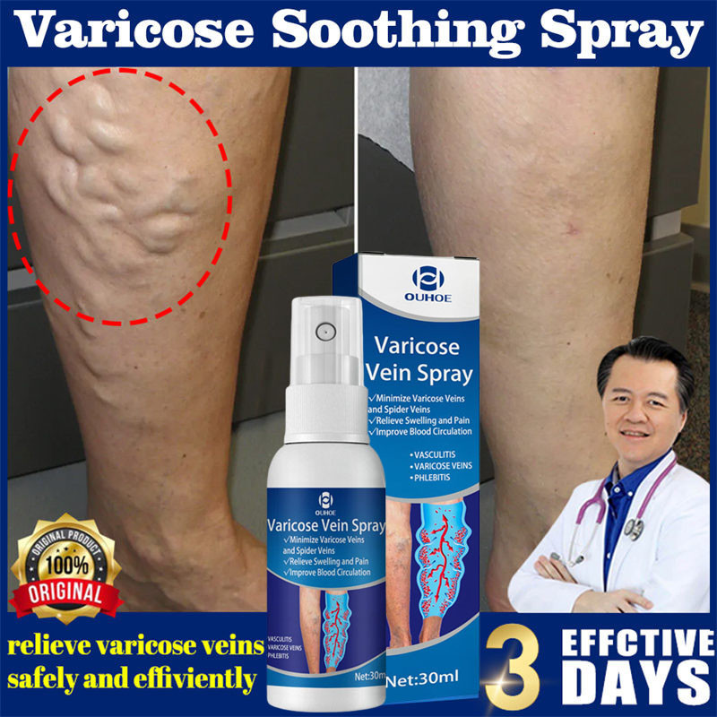 Effective Varicose Vein Treatment Spray Spider Varicose Vein Pain ...