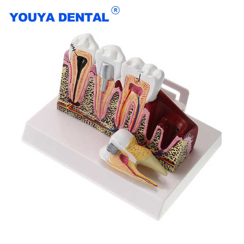 Anatomical Structure Standard Teeth Teaching Model Comprehensive Tooth ...