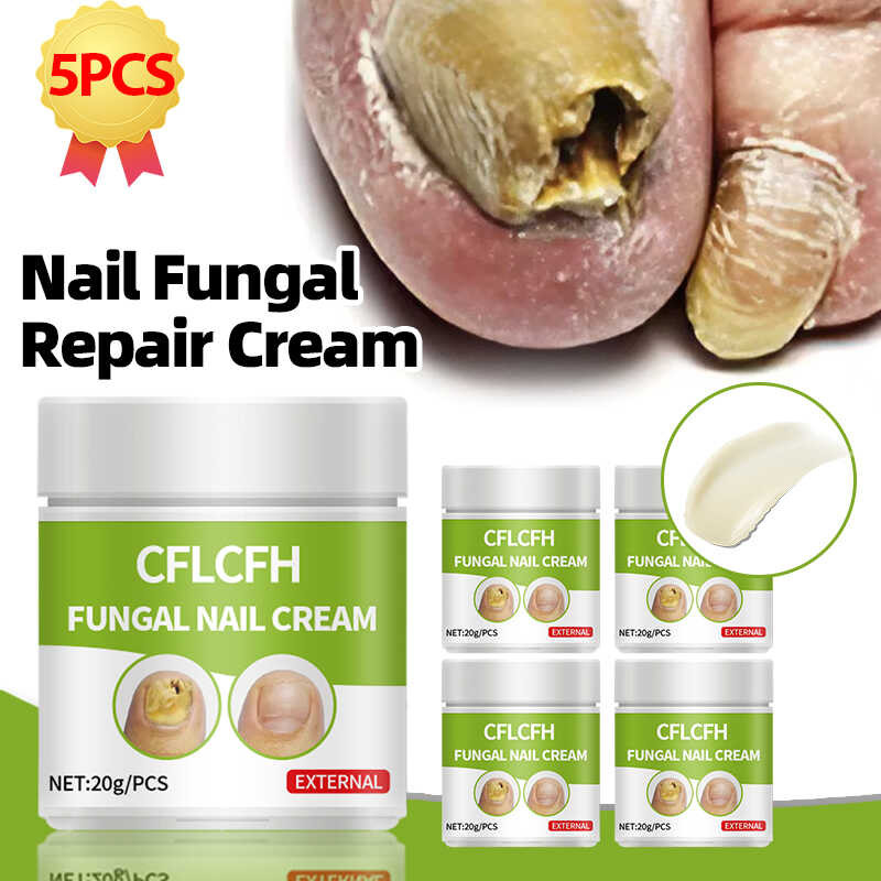 Fungus Treatment Cream Onychomycosis Removal Paronychia Foot Toe ...