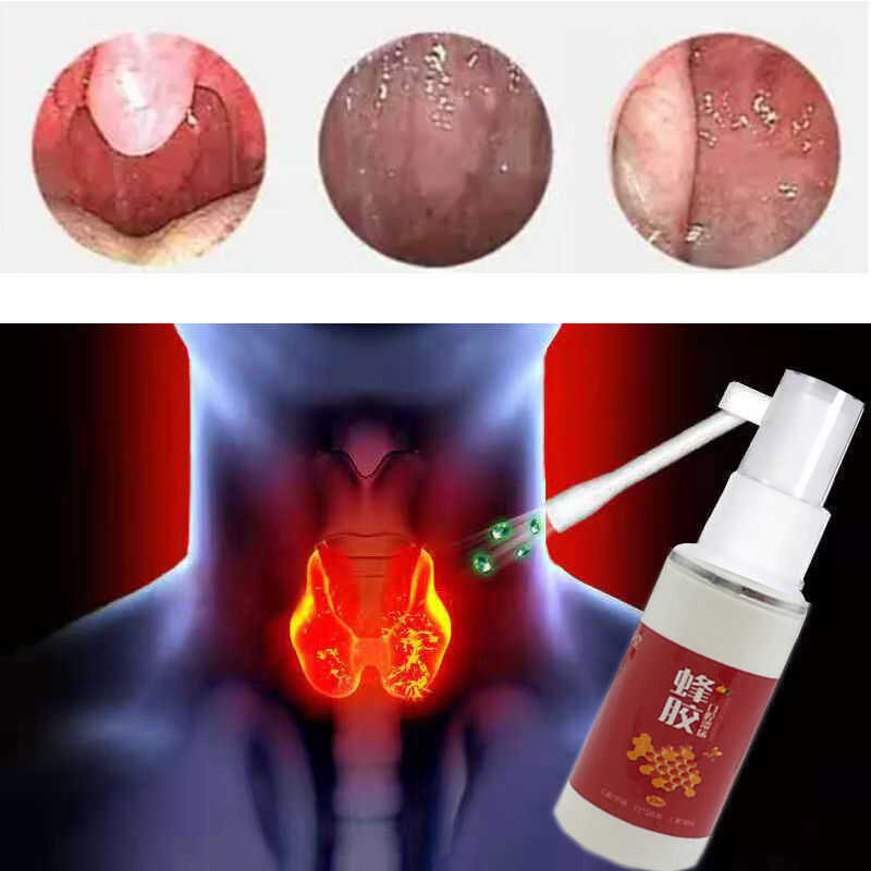 30Ml Mouth Clean Spray Treat Oral Ulcer Pharyngitis Halitosis Sore ...