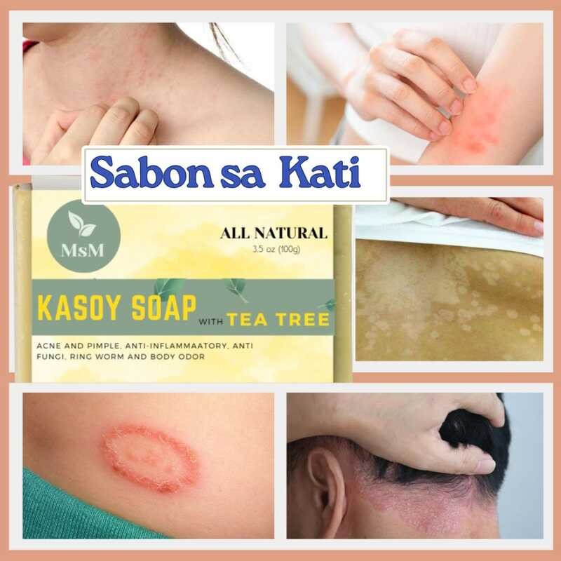 Tinea Versicolor (An An) Soap Remover - Skin Treatment For Allergy ...