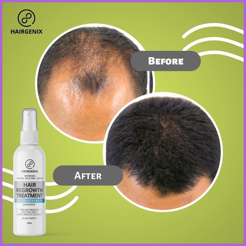 ∇ ๑ Hairgenix Hair Grower Minoxidil 5% Extra Strength Hair Loss ...