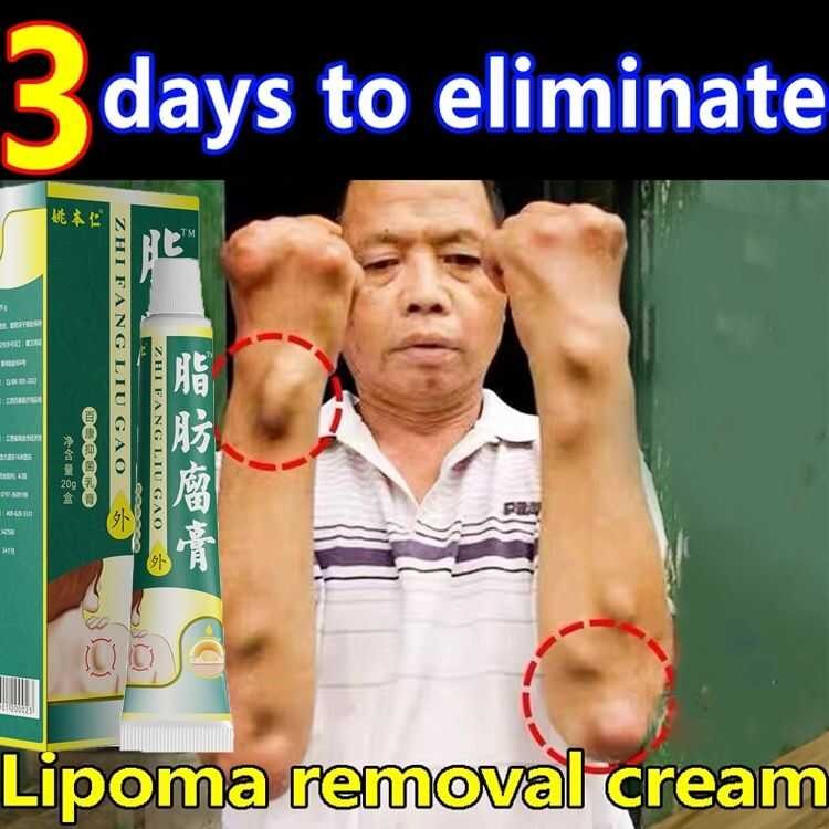 Lipoma Removal Cream Original Japan Bukol Treatment Tumor Skin Swelling ...