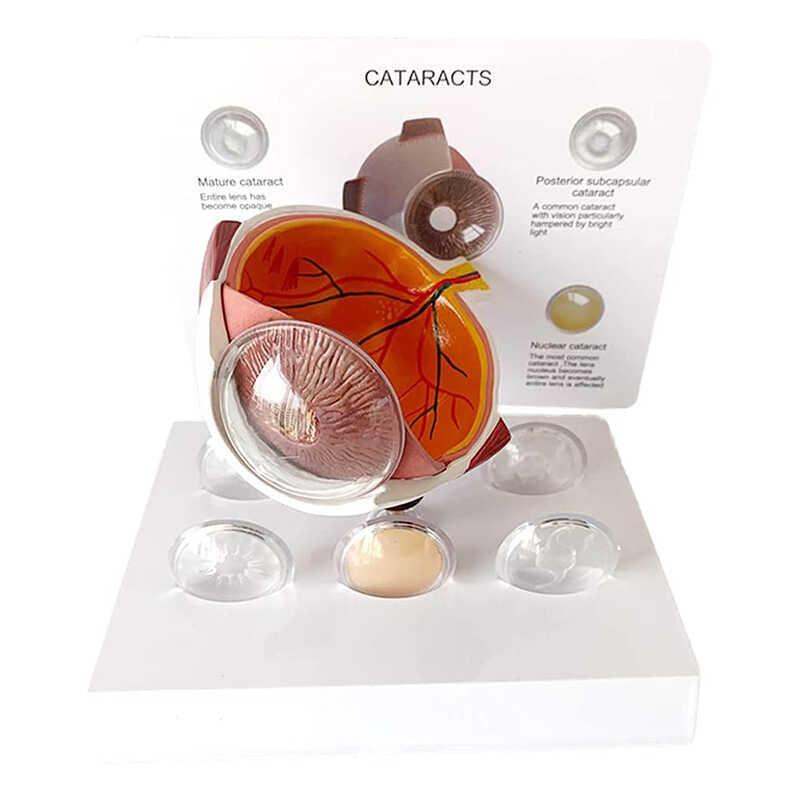 Cornea Eye Human Eye Demonstration Prop Cataract Anmedical Ching Model ...