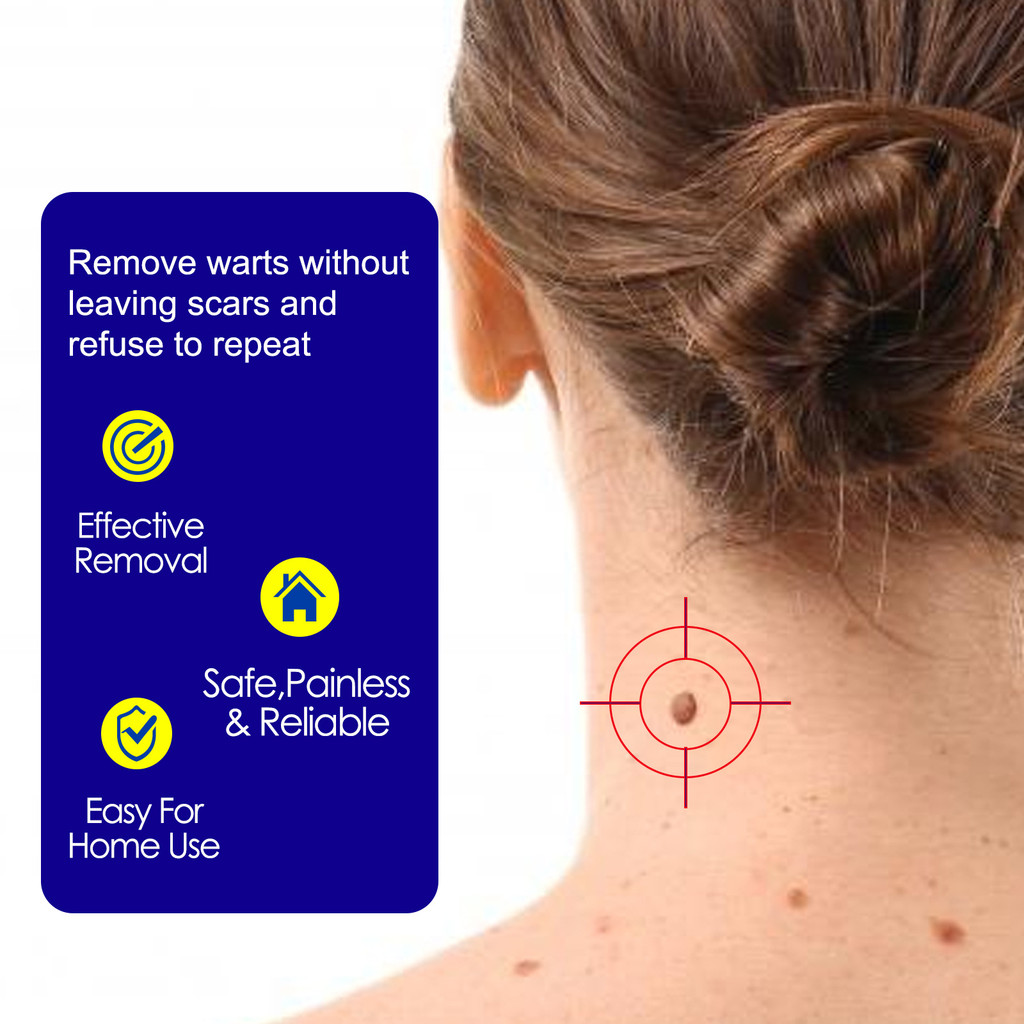 Warts Removal Cream Mole Skin Tags And Warts Remover Ointment Painless ...