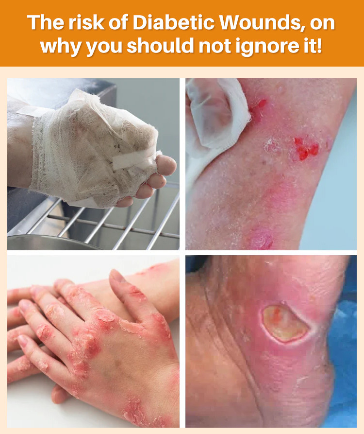 【Buy 1 Free 1】Diabetic Wound Treatment Cream/Wound Care Pressure Sore ...