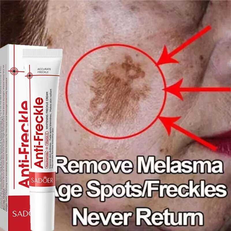 Whitening Original Restoration Powerful Freckles Face Cream Dark Spot Corrector Removal Melasma ...