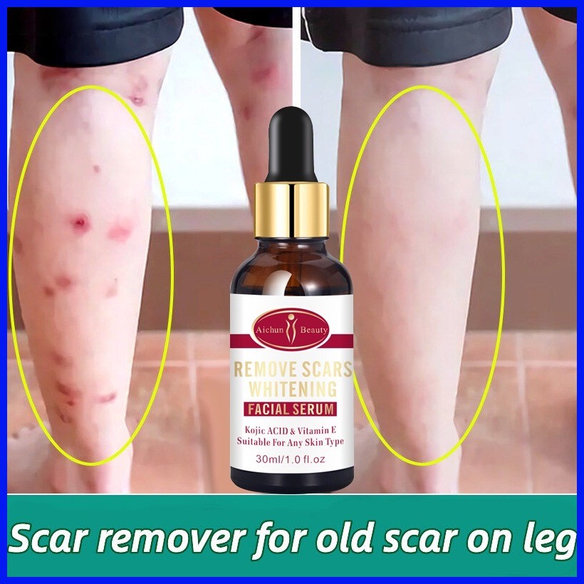 ♀ acne scar remover gold old scars pimple treatment bio oil labena 30ml ...