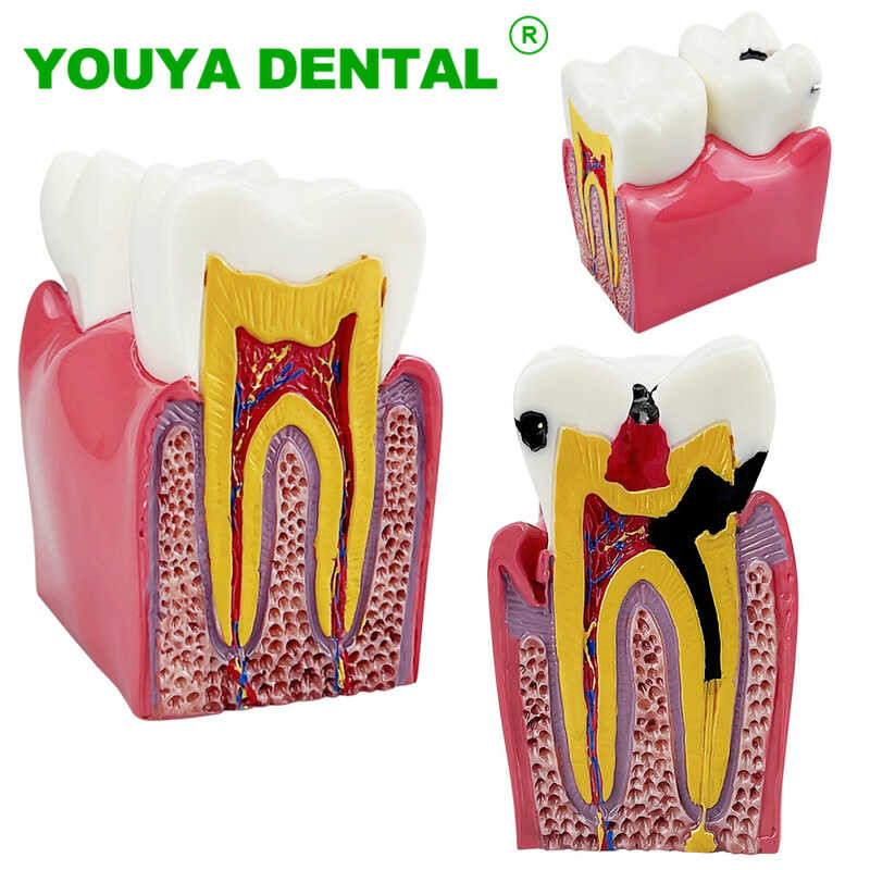 Teeth 6 Times Dental Caries Comparsion Study Models Tooth Decay Model ...