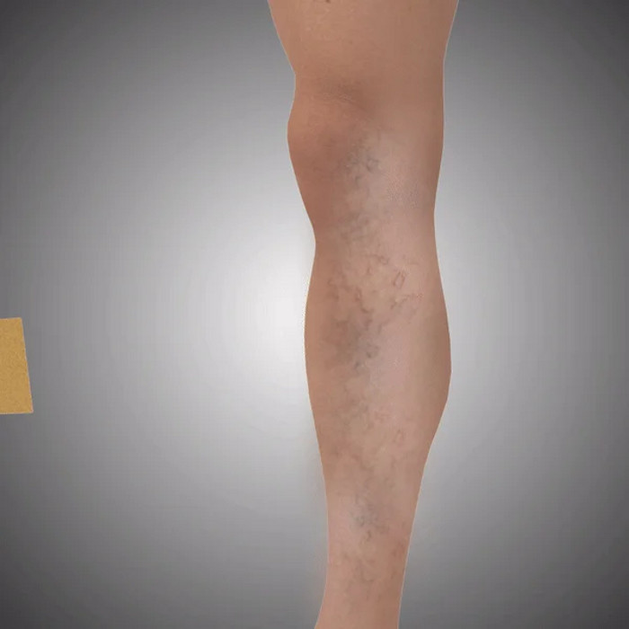 Leg Care Patch Gentle Care Relief of Bulging Tendons Repair Varicose ...