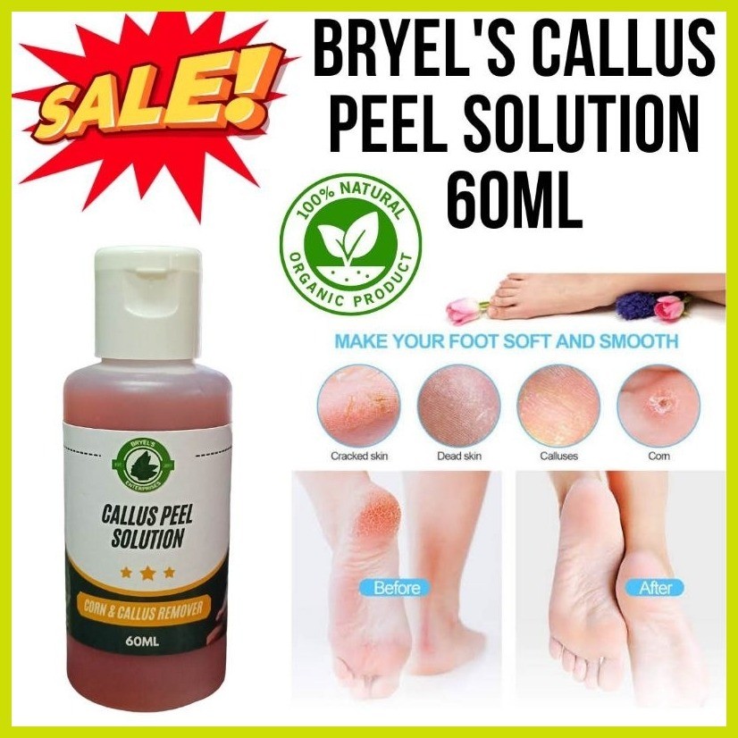 Callus Set Remover/Callus Peel Remover/Pantanggal Kalyo/Callus Peel Solution | Shopee Philippines