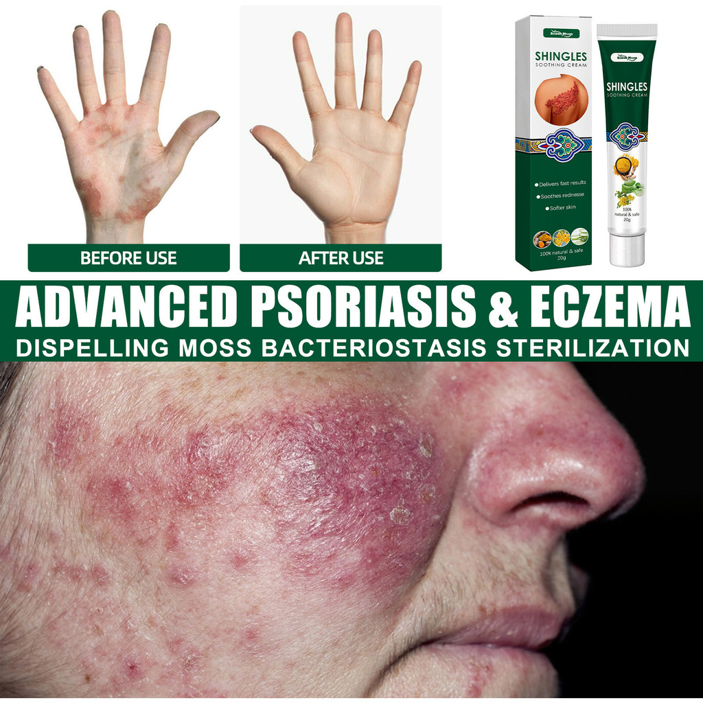South Moon Shingles Soothing Cream Dermatitis Eczema Ointment Anti ...