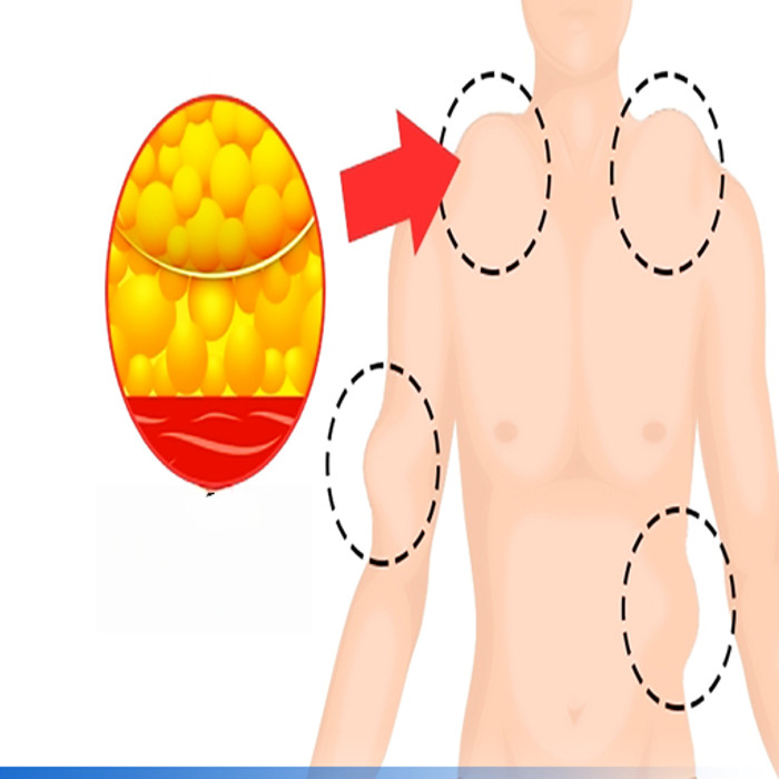 Fatty Knot Cream for Body Care Unclogging and Dispersing Subcutaneous ...