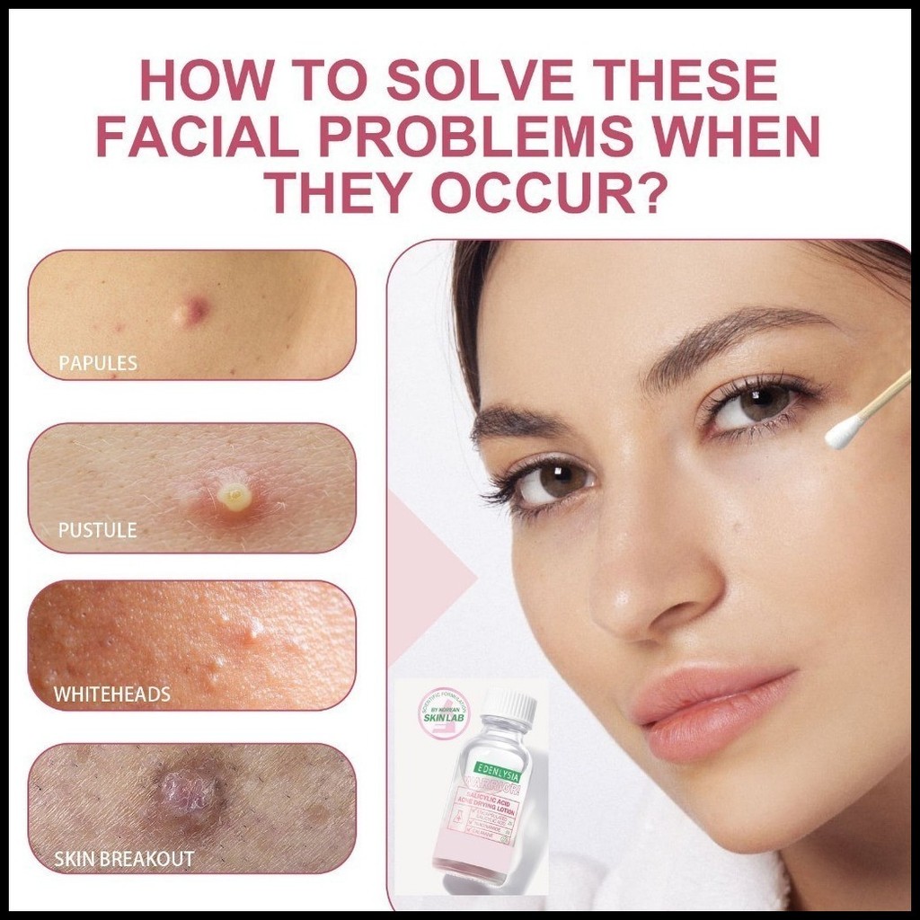 BUY 1 TAKE 1】30ML Pimple Warrior Salicylic Acid Acne Drying Lotion ...