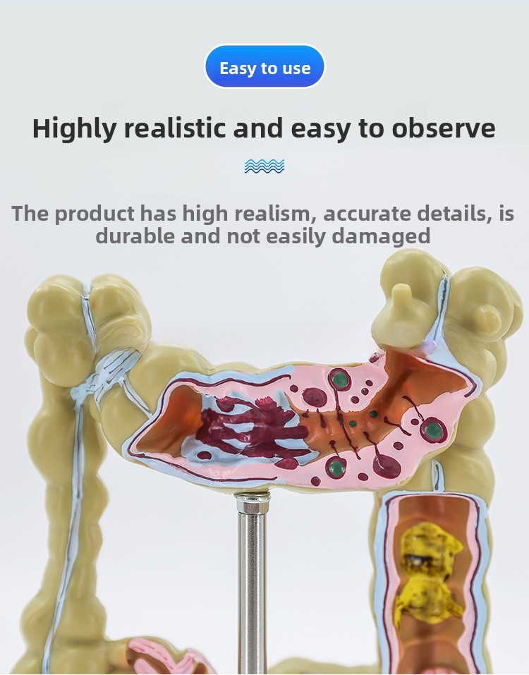 Large Intestine Pathology Model Small Large Intestine Model Large ...