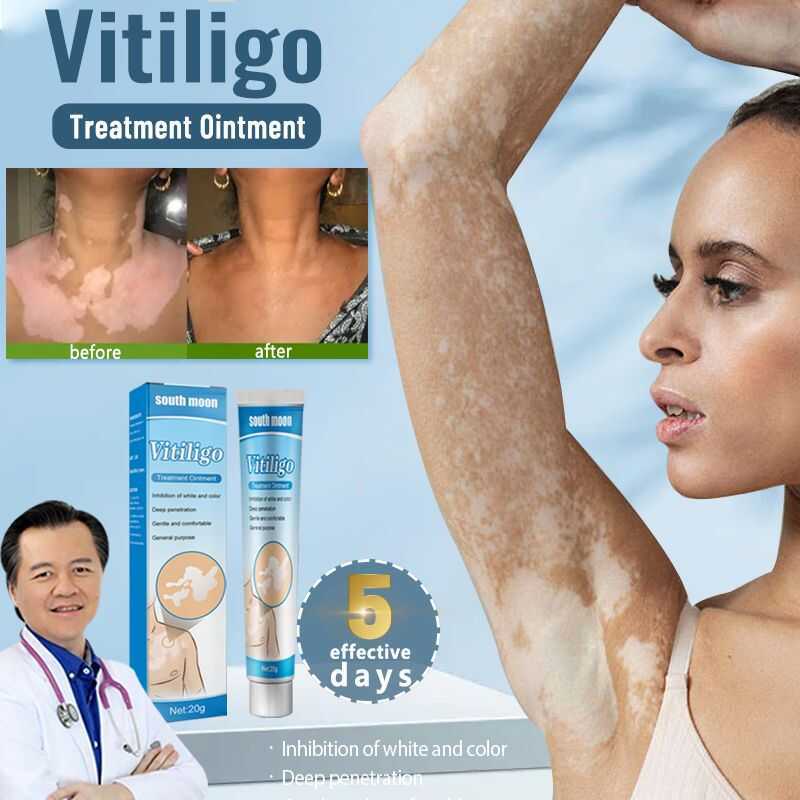 Vitiligo Treatment Cream Atoderma Original Remover Opzelura For ...