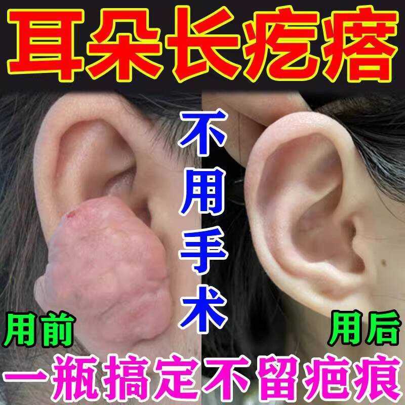 Piercing Treatment Solution Ear Special Medicine Cleaning Scar ...