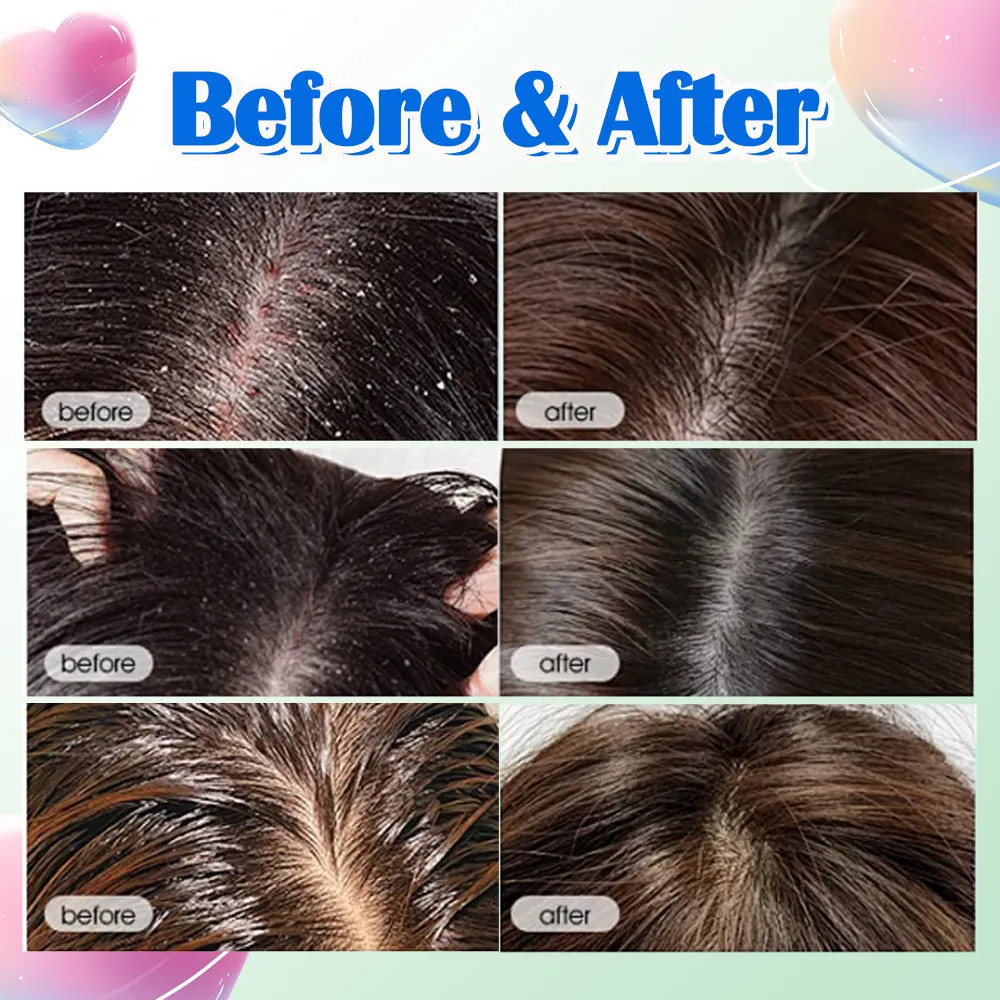 TEN TWENTY Remover Lice & Nits Shampoo 300ml – for child, adults Deep ...