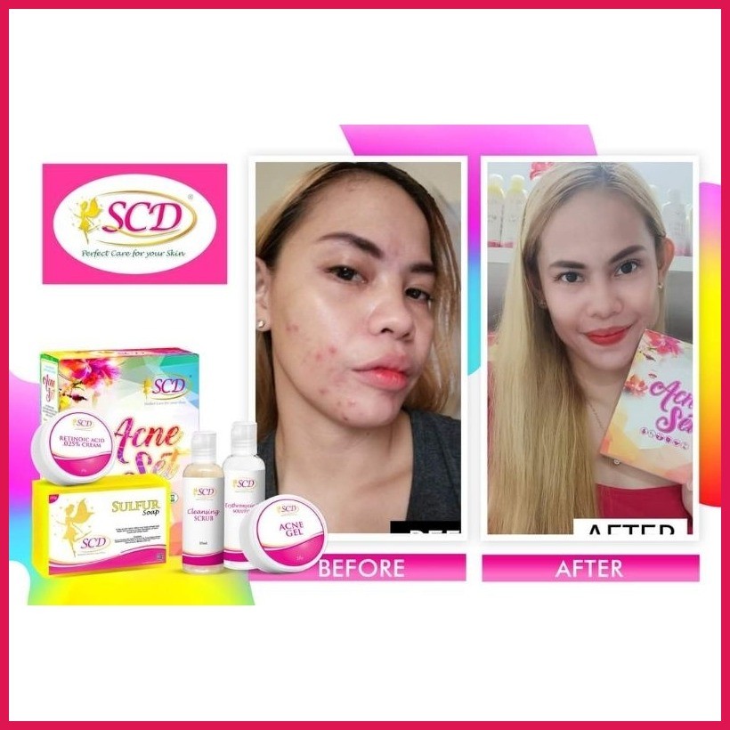 SCD 5in1 Acne Set - (Sulfur Soap, Scrub, Solution, Retinoid Cream, and ...