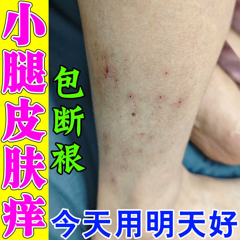 Bumps Itchy Calf Skin, Hot Weather Leg Groin Itching, Stubborn ...