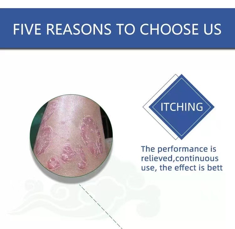 Eczema Psoriasis Cream Herbal Antibacterial Anti Itch Relief Eczema ...
