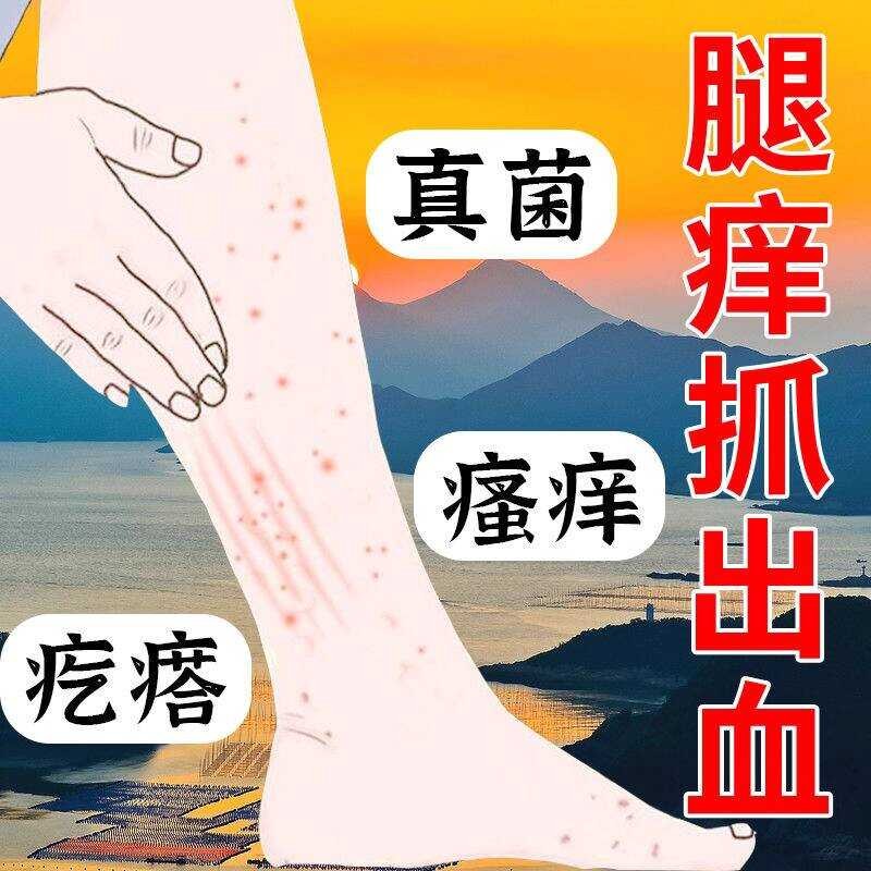 Calf Summer Eczema Adult Anti-Itch Ointment Sweating Body Skin Itching ...