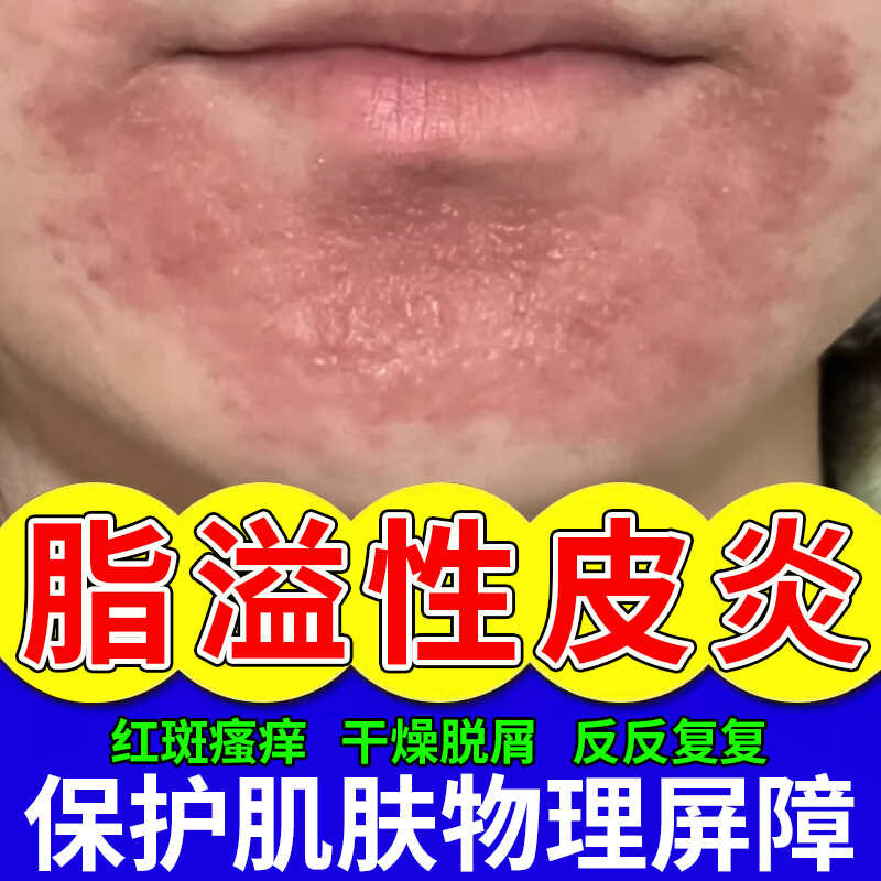 Seborrheic Dermatitis Facial Face Mouth Corner Chin Nose Wing Skin Care ...