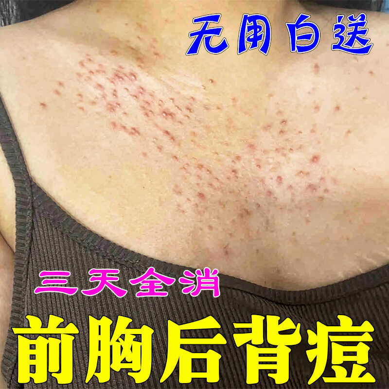 Pimples Chest Back, Red Bumps On Body, Itching, Acne, Fungal Infection ...