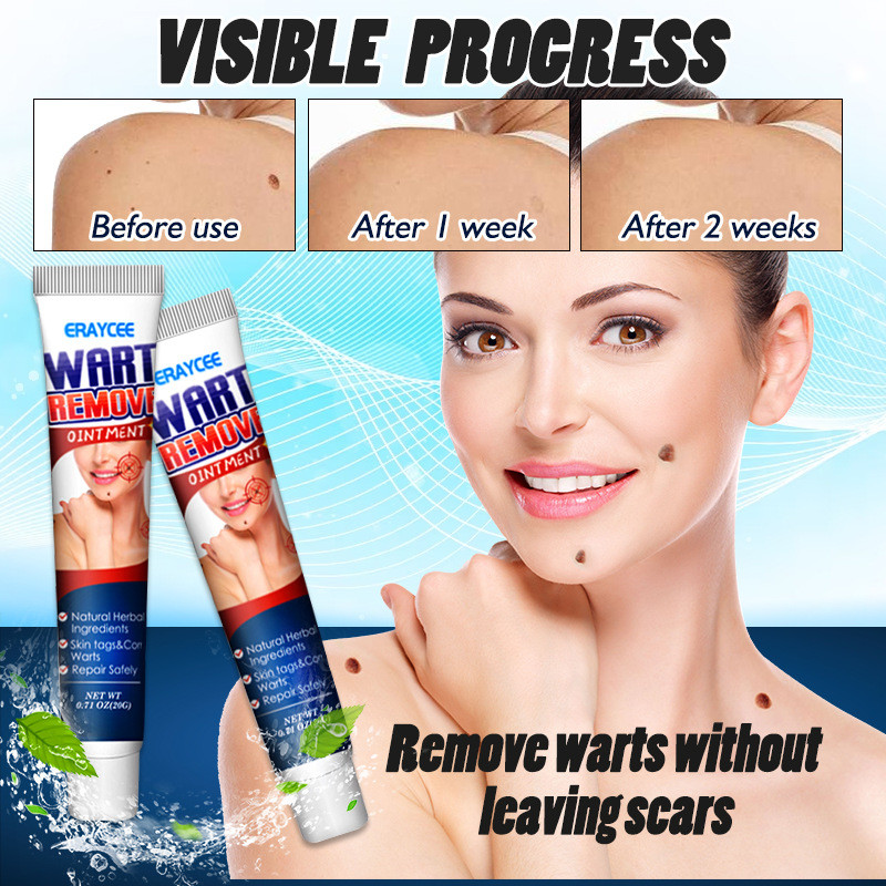 Herbal warts skin tag removed | Shopee Philippines