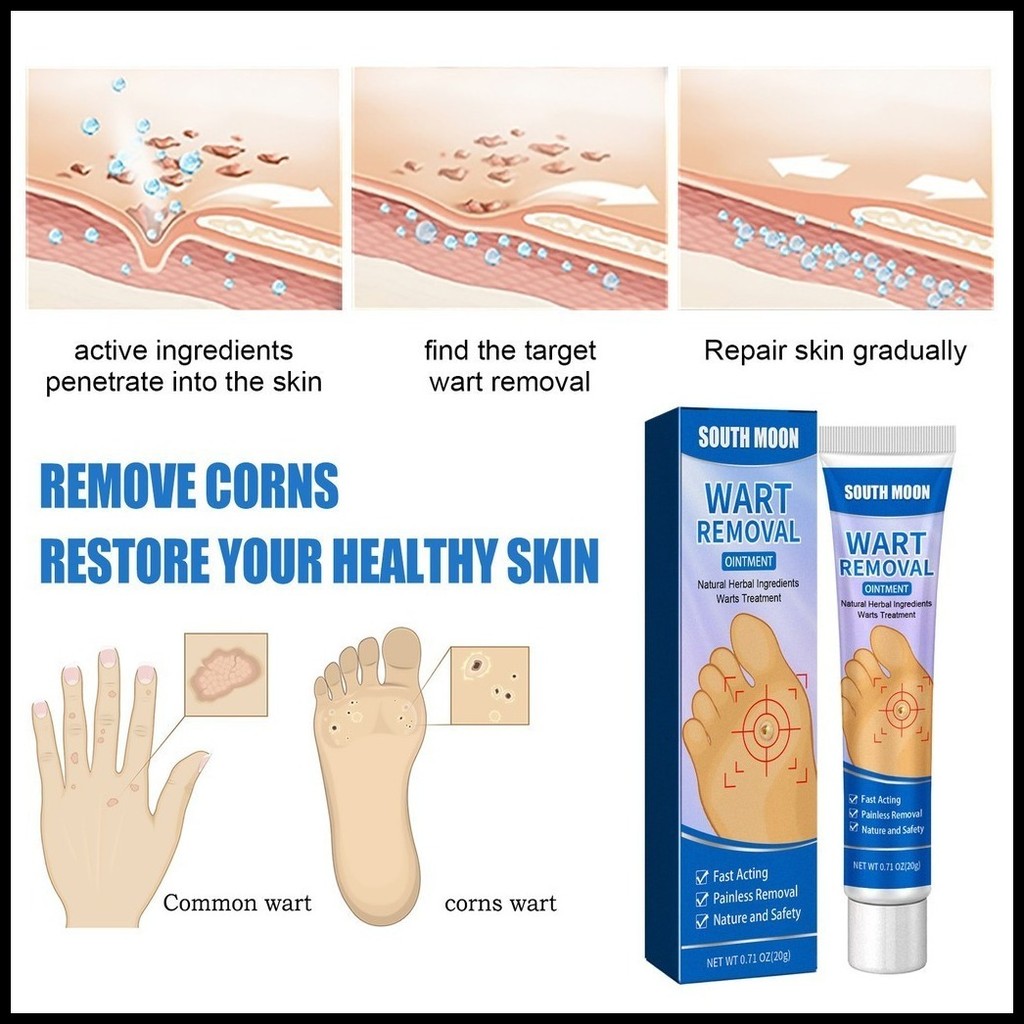 South Moon Callus Remover Cream Flat Wart Removal Cream for Plantar ...