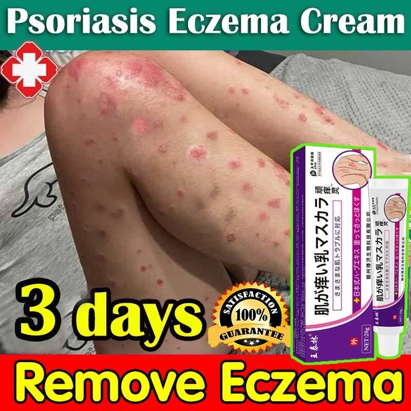 Eczema 20G Ointments For Deases Gamot Kati Sa Balat Psoriasis Treatment ...