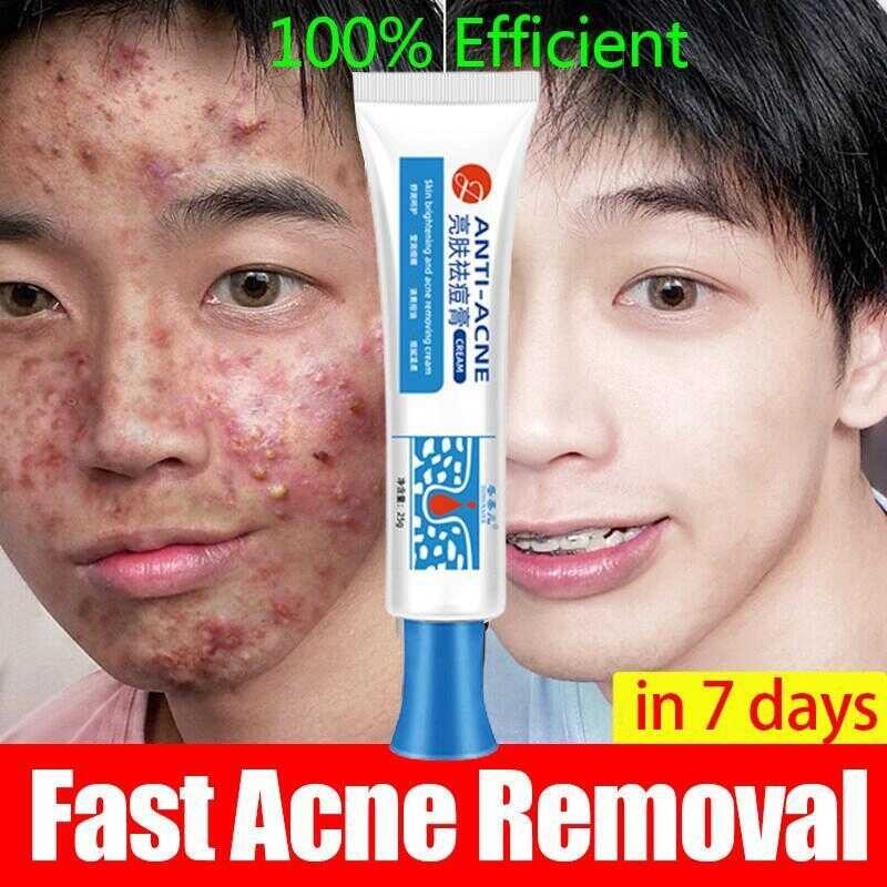 And Acne Freckle Removal Anti-Acne Cream/100% Effective /Fast Cream ...