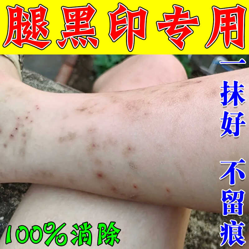 Leg Scratch Acne Marks Burns Mosquito Bites Dark Spots Fading Melanin ...